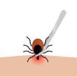 How to safely remove a tick | Louisville, Ky.Norton Healthcare