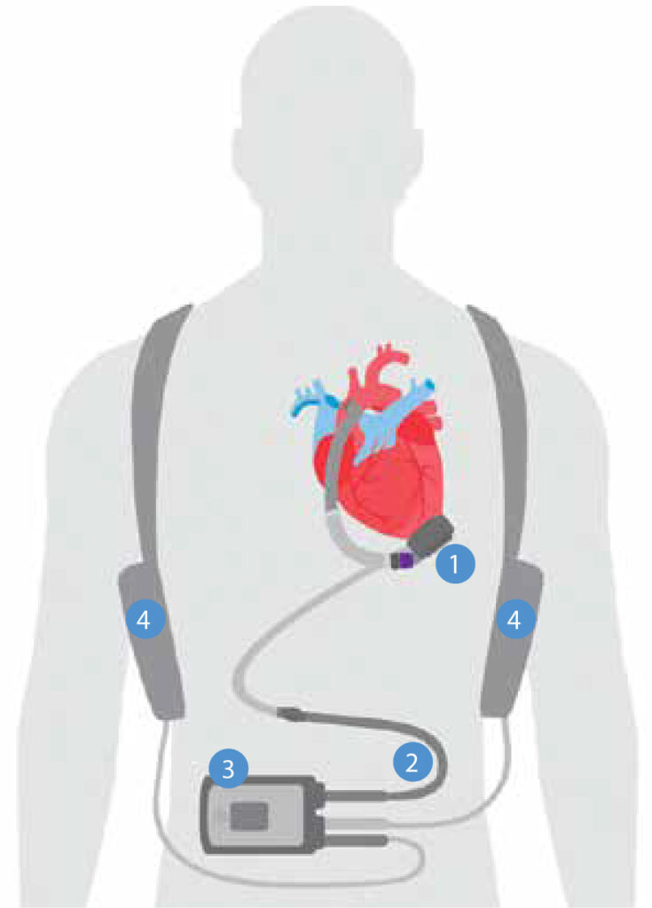 VAD – Ventricular Assist Device | Norton Healthcare Louisville, Ky.